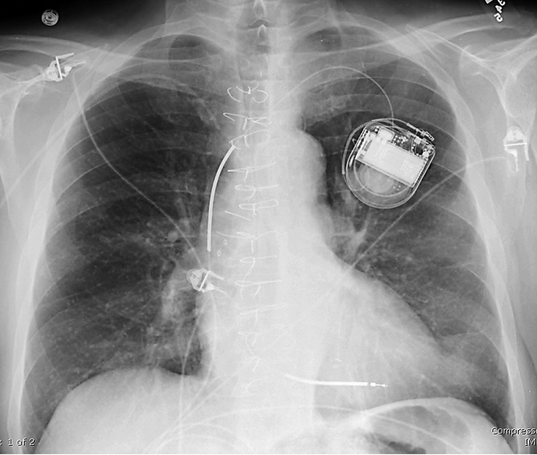 Gli hacker colpiscono anche i pacemaker – Enkey Magazine